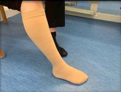 Advice for Applying and Wearing Compression Garments | Dorset County ...
